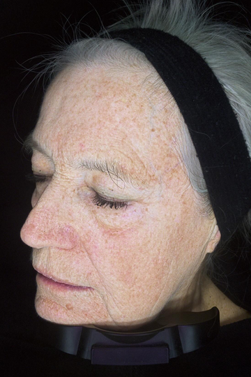 Mole Mapping – Derm.ca