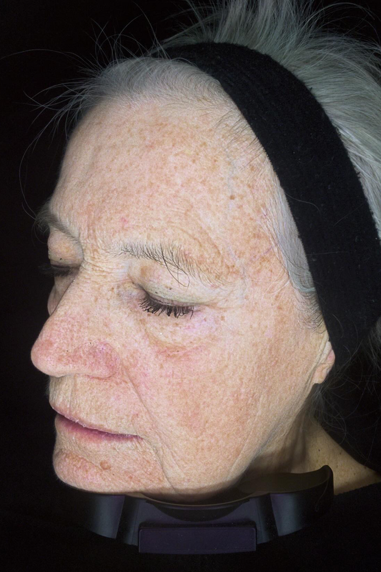 Digital Mole Mapping Calgary | Skin Cancer Detection | Derm.ca