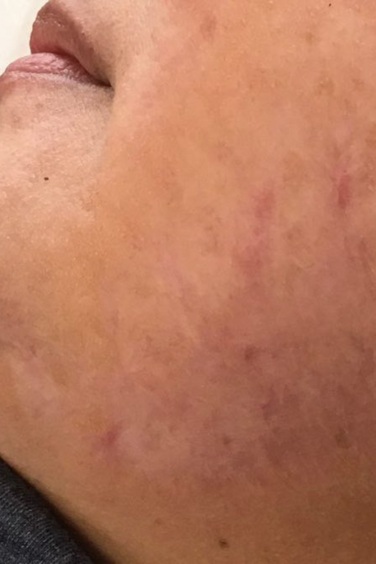 Digital Mole Mapping Calgary | Skin Cancer Detection | Derm.ca