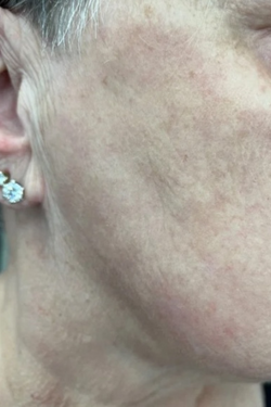 Mole Mapping – Derm.ca